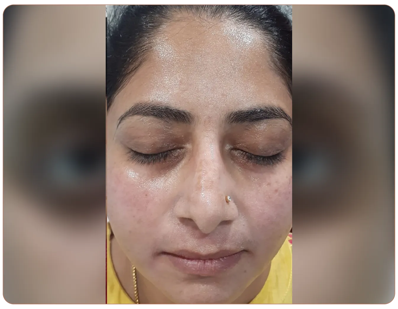Pigmentation Treatment Before & After Images at Kolors