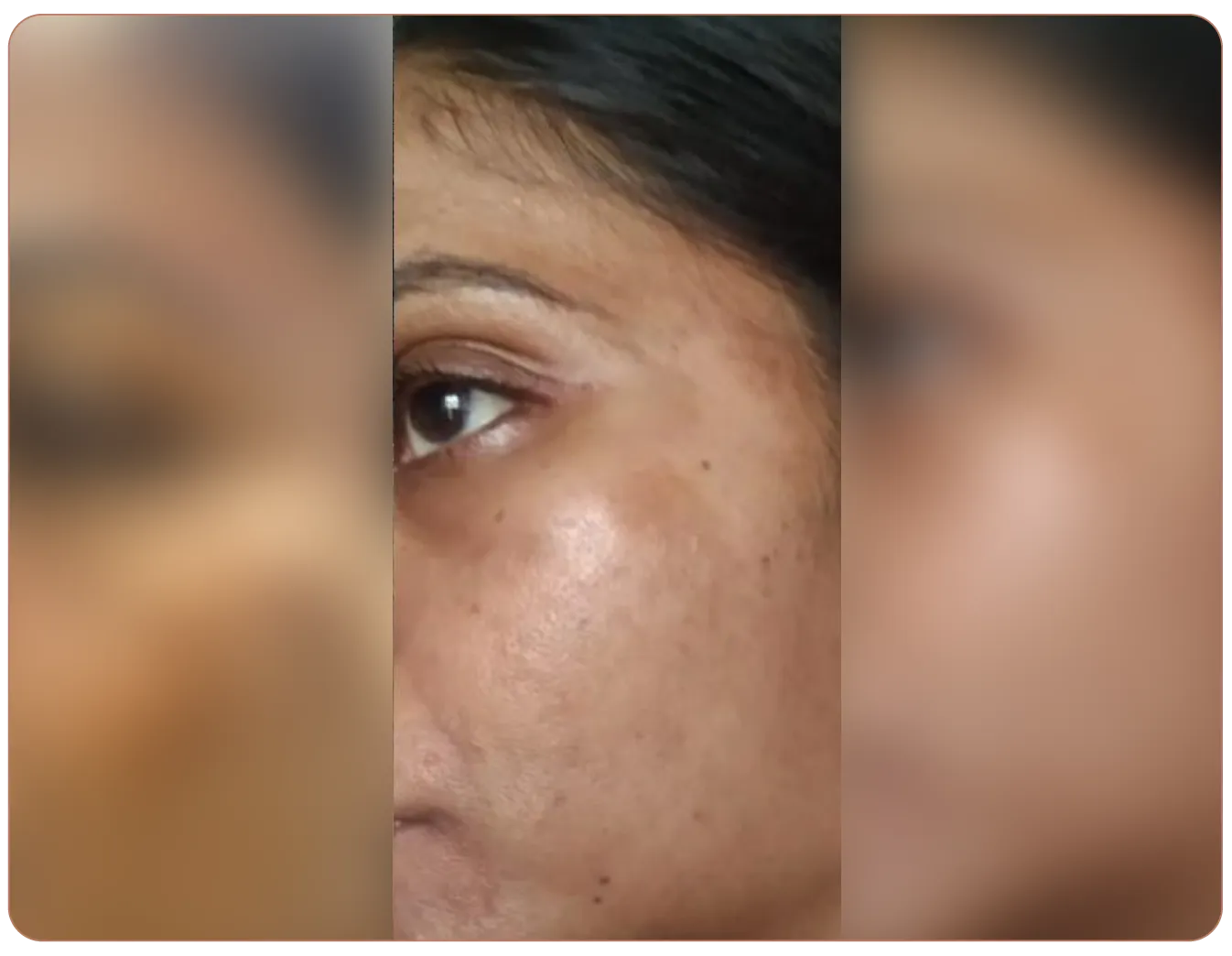 Pigmentation Treatment Before & After Images at Kolors