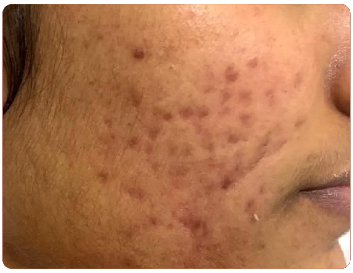 Kolors Hair and Skin - Pimples Treatment Images