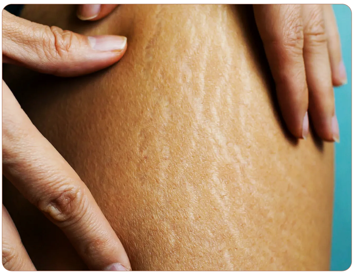 Kolors Hair and Skin - Stretch Marks Removal Images