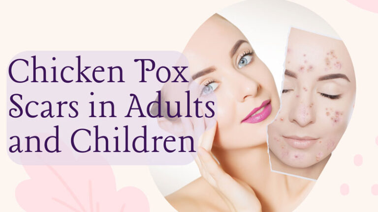 How To Remove Chicken Pox Scars in Adults and Children