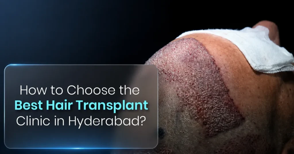 How to Choose the Best Hair Transplant Clinic in Hyderabad?